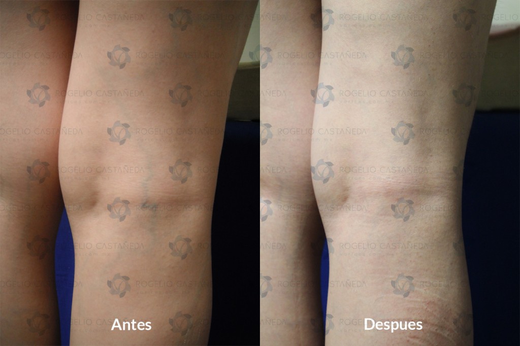 Galerias Archive - Dr. Rogelio Castañeda