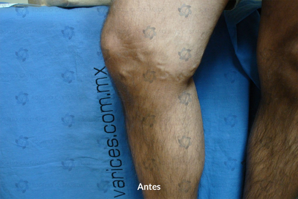 varices-hombres-1 - Dr. Rogelio Castañeda