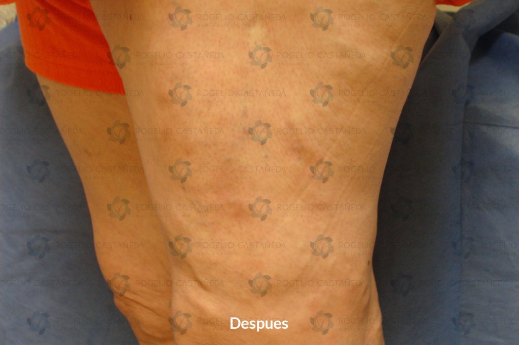 Galerias Archive - Dr. Rogelio Castañeda