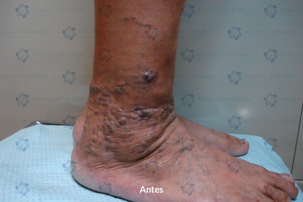 varices-tobillo-3 - Dr. Rogelio Castañeda